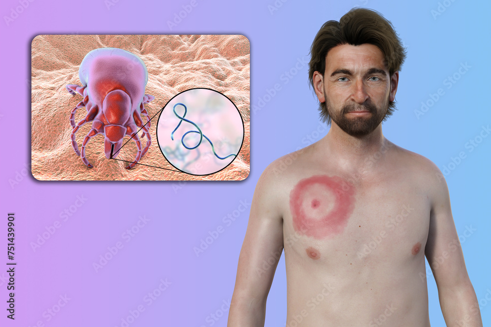 A man with erythema migrans, a characteristic rash of Lyme disease caused by Borrelia ...