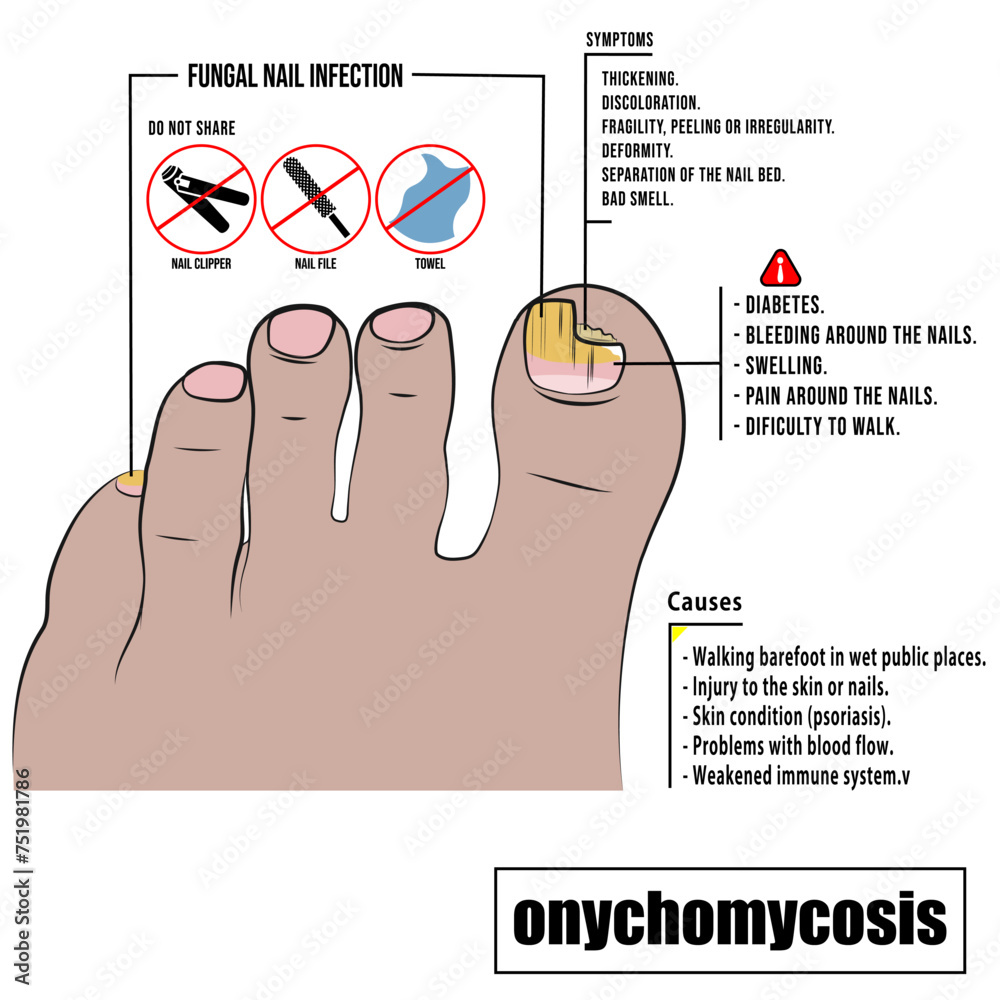 Onychomycosis, fungal infection of the nail plate. Toenail fungus ...
