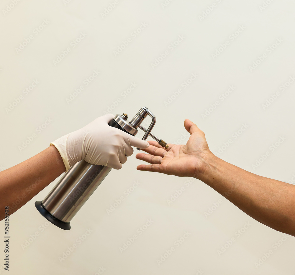 Dermatologists use liquid nitrogen to treat hand scar, Cryotherapy ...