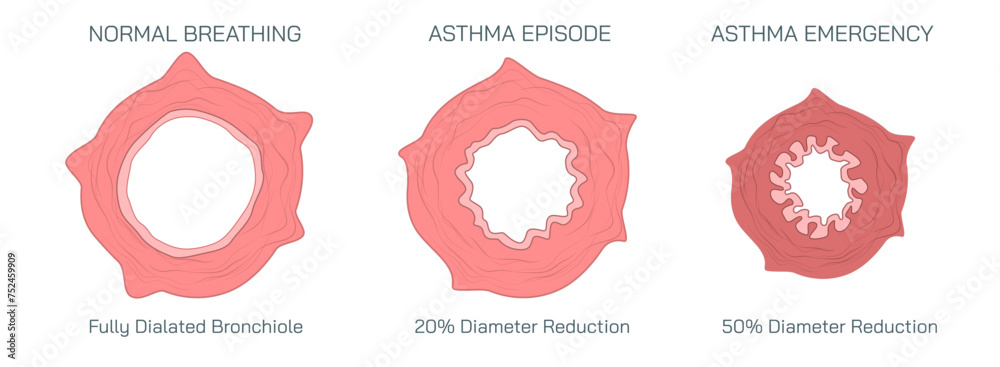 Bronchial asthmatic symptoms. Bronchitis is an inflammation of the ...
