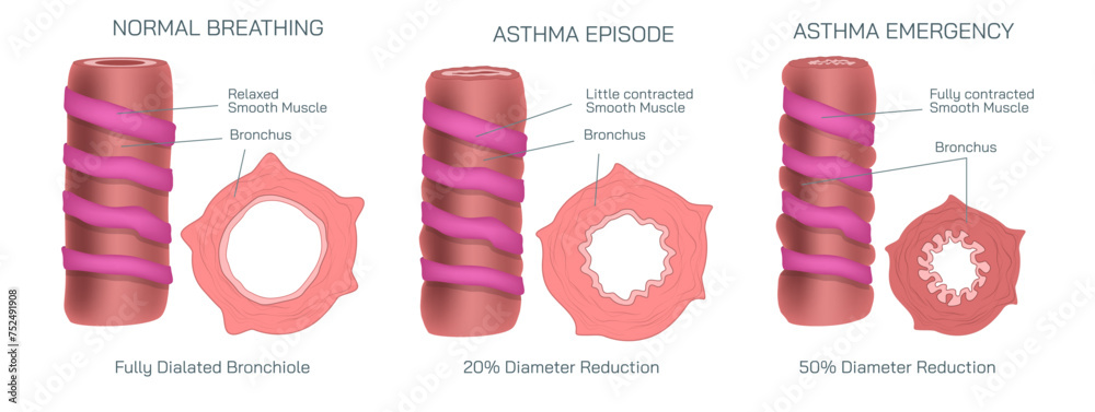 Bronchial asthmatic symptoms. Bronchitis is an inflammation of the ...