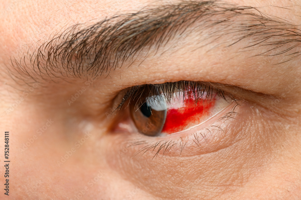 a human eye with a burst vessel and blood leaking into the eyeball ...