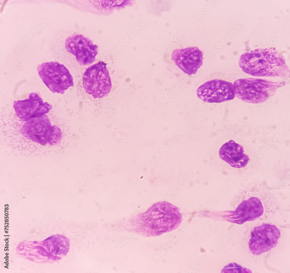 Blood cancer. Photomicrograph of Acute Myeloblastic Leukemia or AML, a ...