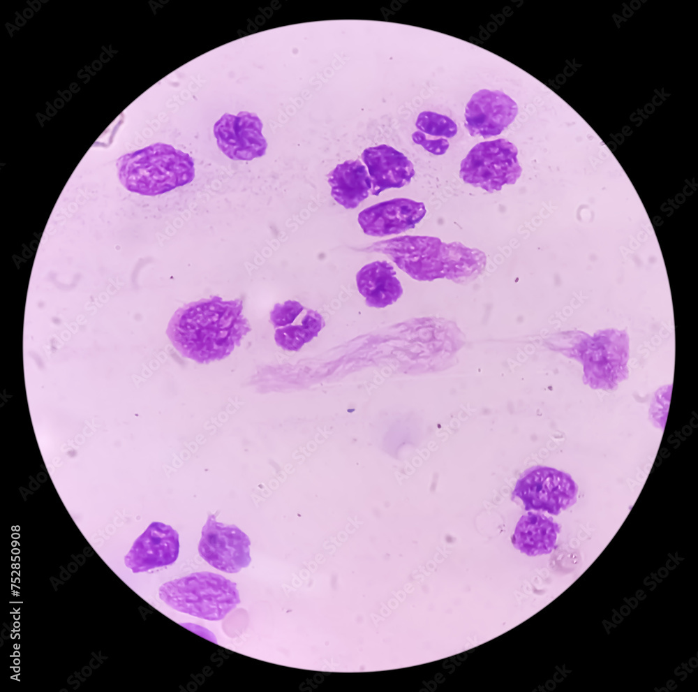 Blood cancer. Photomicrograph of Acute Myeloblastic Leukemia or AML, a ...
