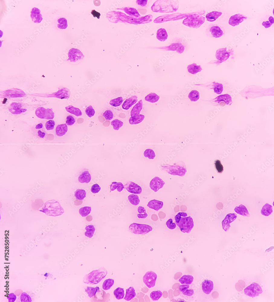 Blood cancer. Photomicrograph of Acute Myeloblastic Leukemia or AML, a ...