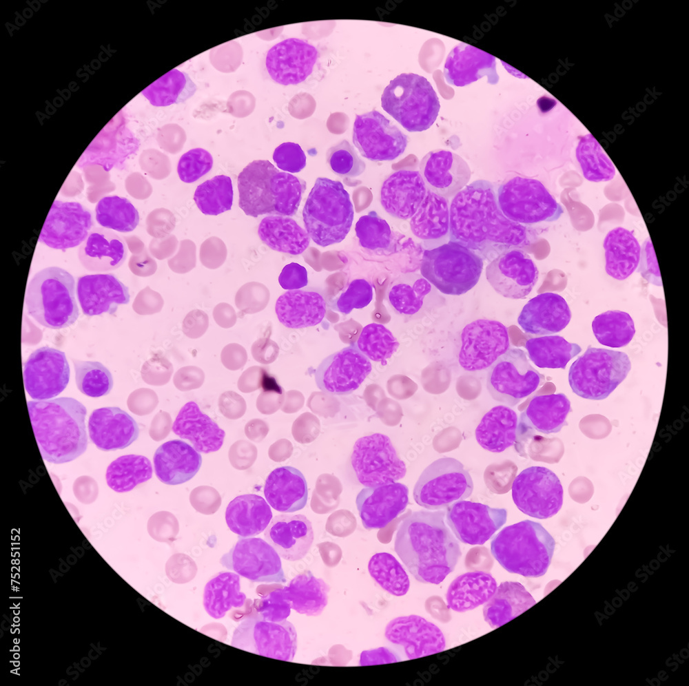 Blood cancer. Photomicrograph of Acute Myeloblastic Leukemia or AML, a ...