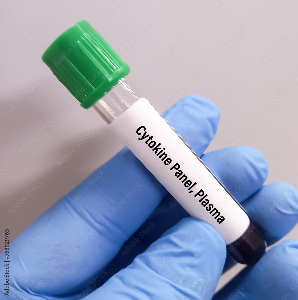 Blood sample for Cytokine test, used to pathophysiology of immune ...
