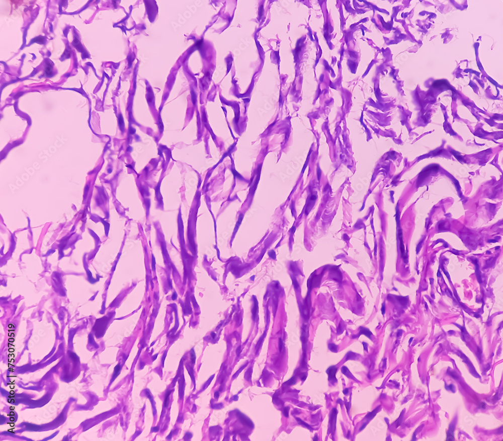 Microscopic image of above knee amputation. Section show fibro ...