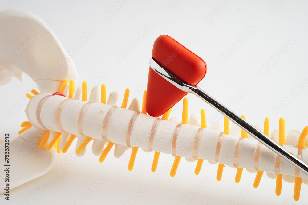 Spinal nerve and bone with knee reflex hammer, Lumbar spine displaced ...