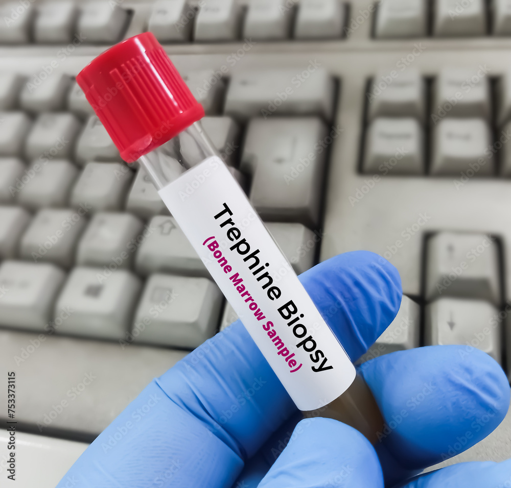 Bone marrow sample for Trephine biopsy test, to diagnosis Non-Hodgkin ...