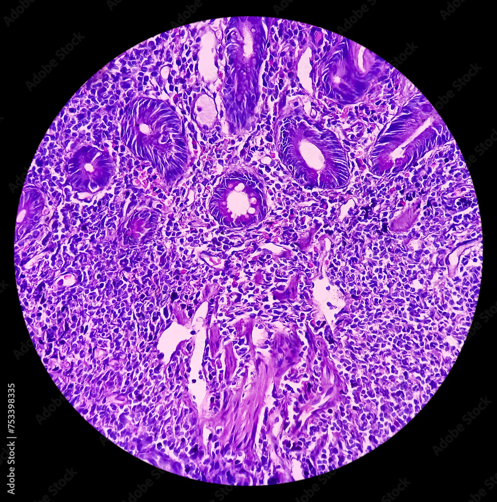 Terminal ileum ( colonoscopic biopsy). Lymphoid hyperplasia. Section ...