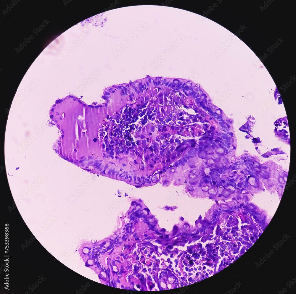 Terminal ileum ( colonoscopic biopsy). Lymphoid hyperplasia. Section ...