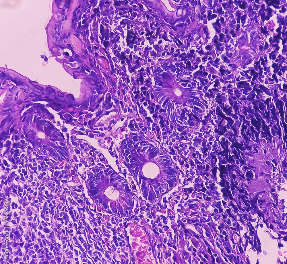 Foto de Terminal ileum ( colonoscopic biopsy). Lymphoid hyperplasia ...