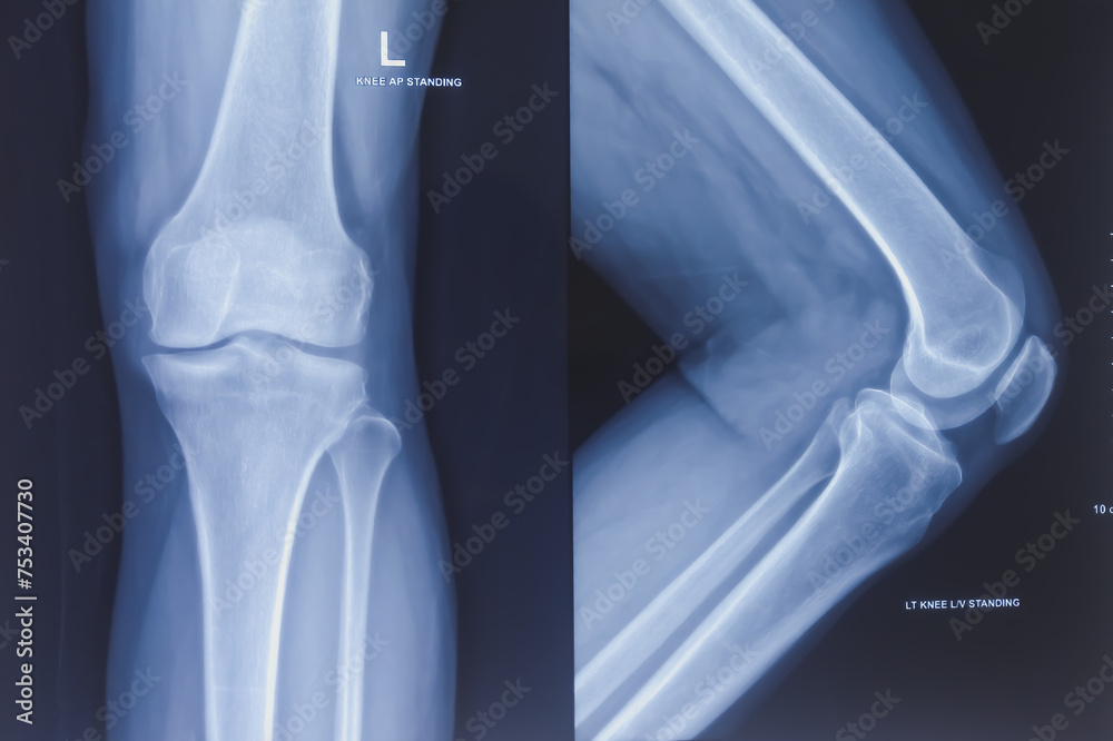 Knee joint x-ray ap and lateral view, Early degenerative osteoarthritis ...