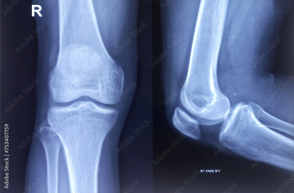 Knee joint x-ray ap and lateral view, normal skeletal. normal findings ...