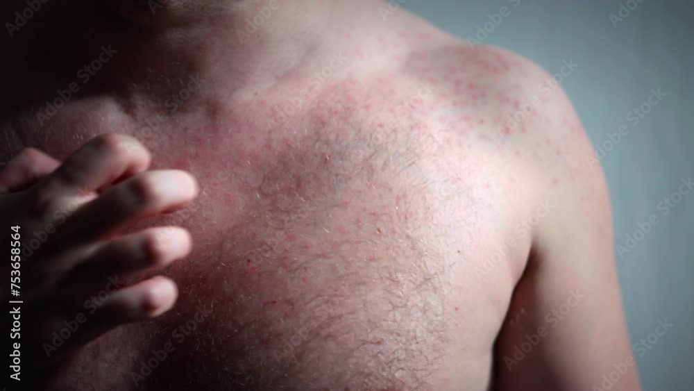 Vidéo Stock Serious rashes of the skin of human chest, small red itchy ...