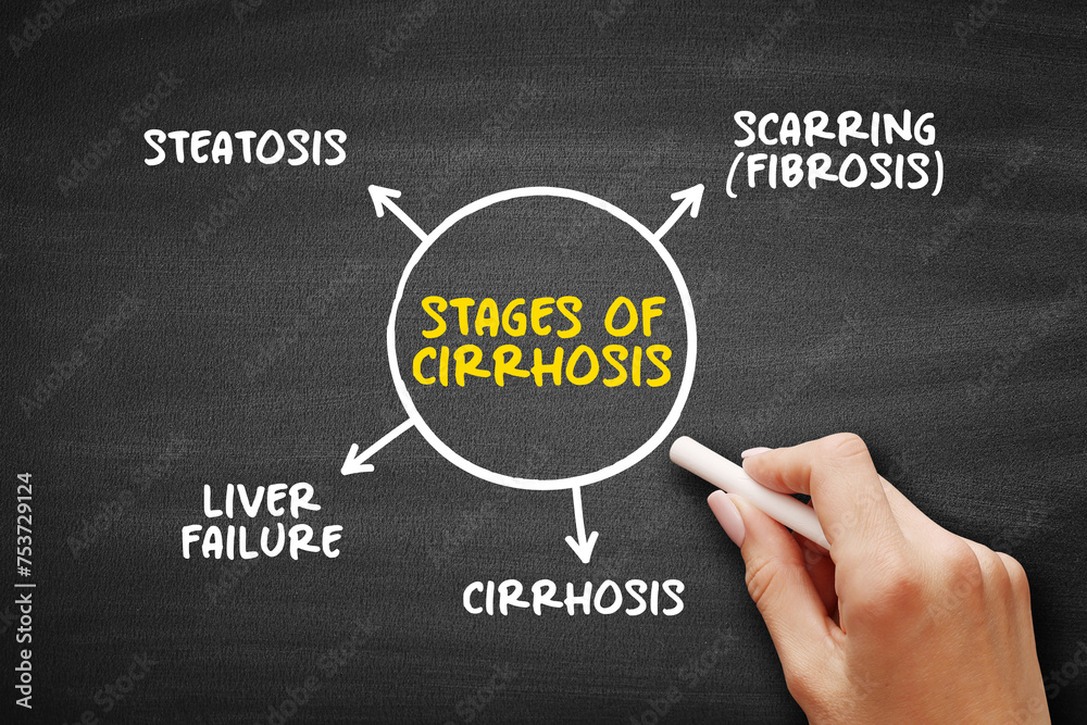 Stages of cirrhosis (scarring of the liver caused by long-term liver ...