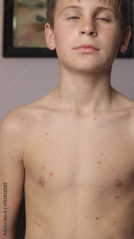 Vertical.The portrait portrays a teenage boy with red lesions covering ...
