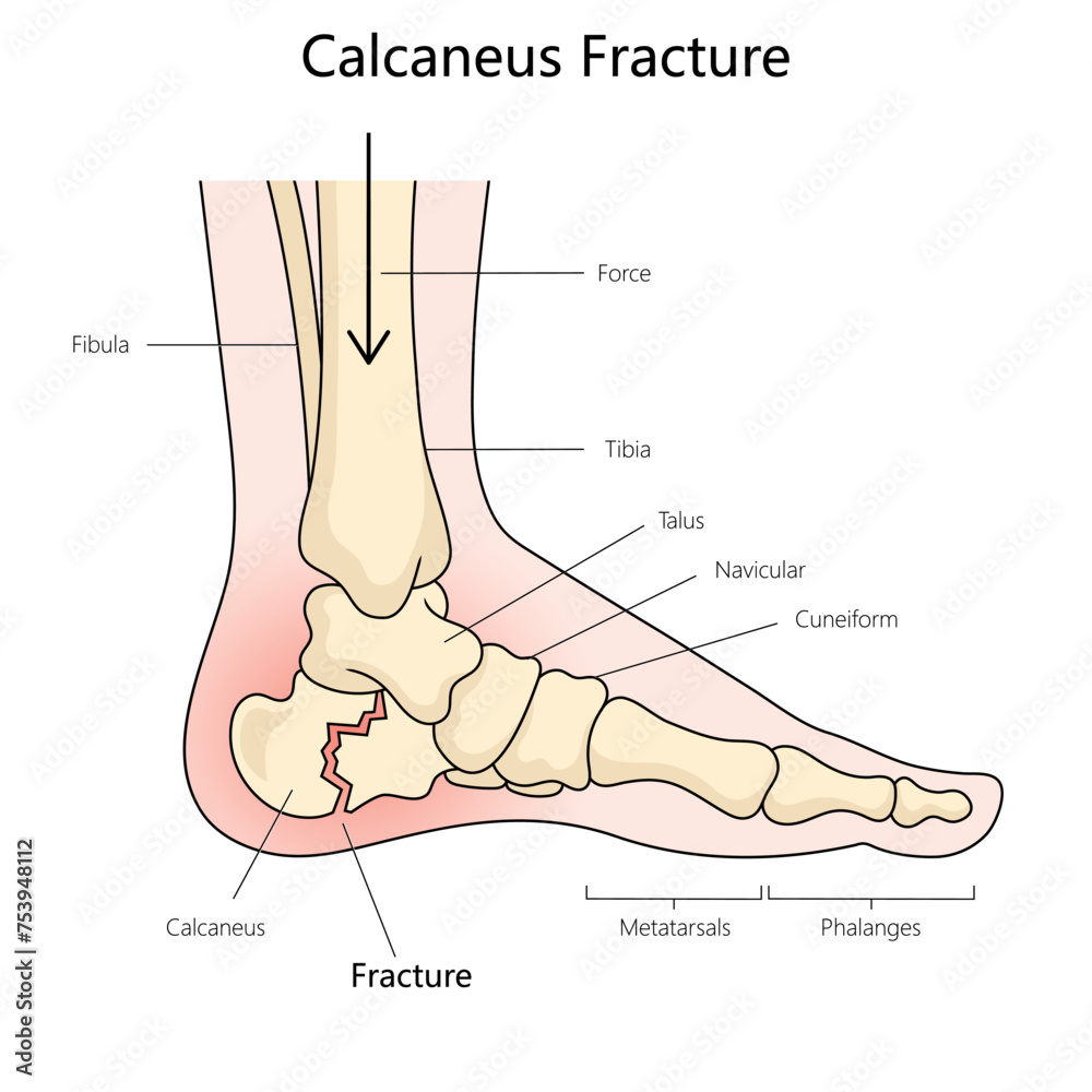 Calcaneus fracture structure diagram hand drawn schematic vector ...