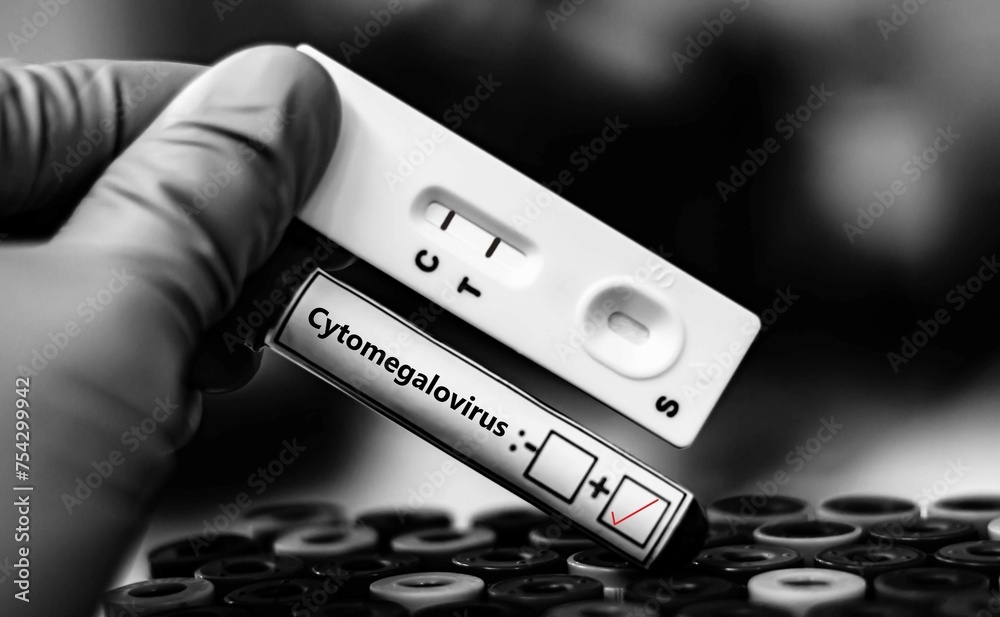 Blood sample of patient positive tested for cytomegalovirus by rapid ...