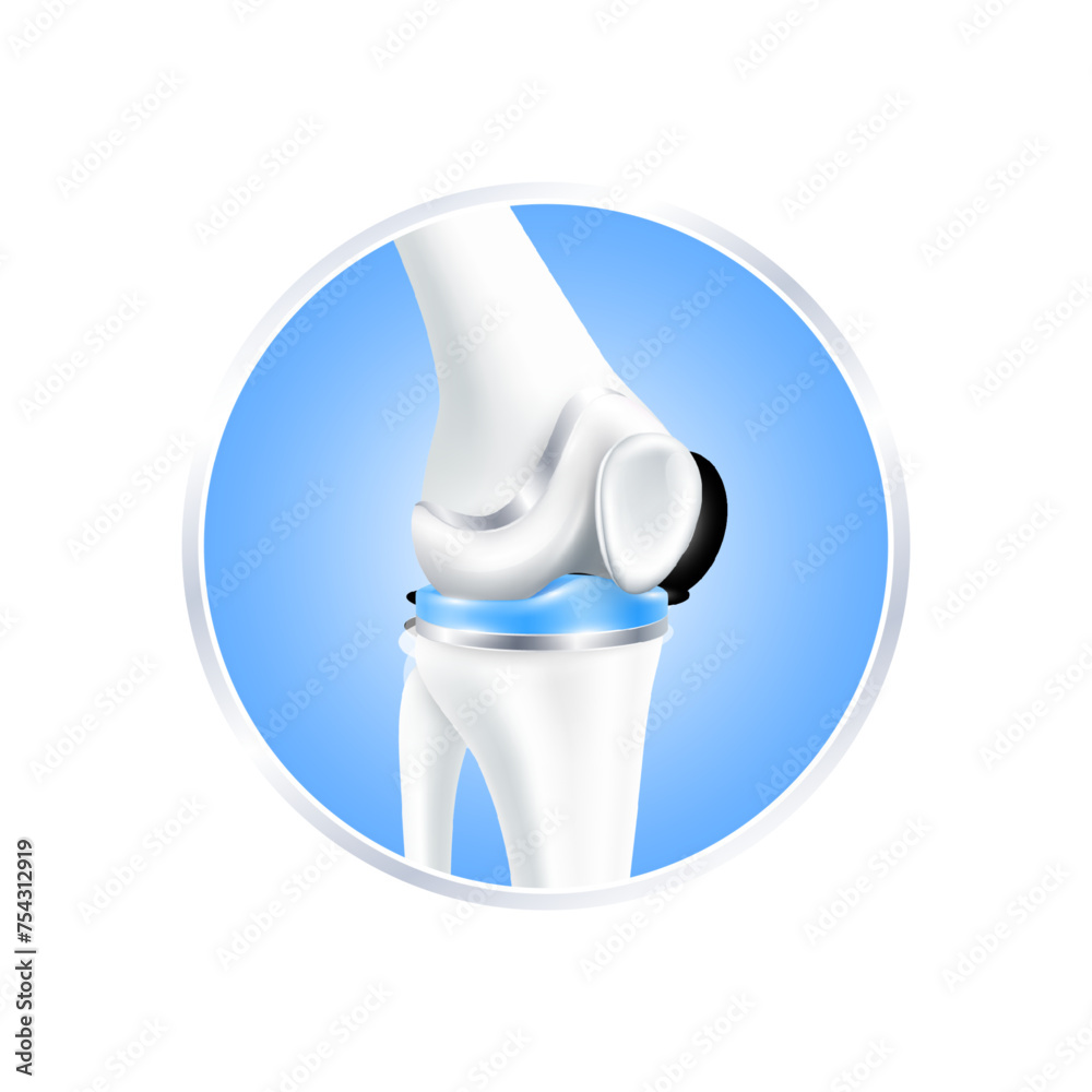 label aluminum. Knee replacement surgery total implant for treatment ...