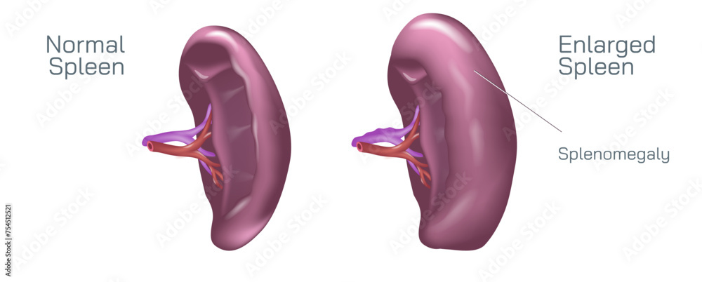 Your spleen is an organ that sits just below your left rib cage. Many ...