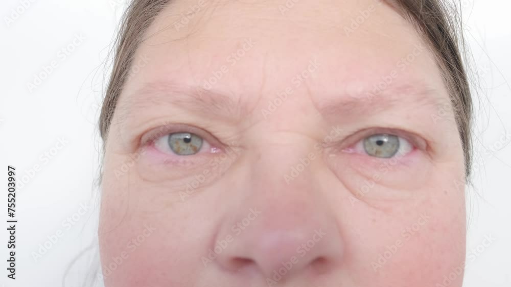 female eyes mature woman, close-up wrinkles, under eyes bags, swelling ...