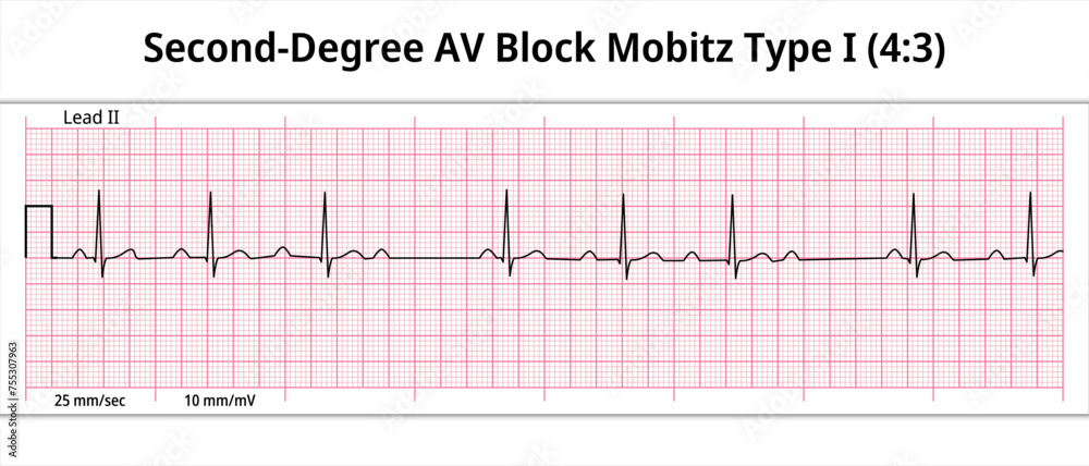 ECG Second Degree AV Block Mobitz Type 1 (4:3) - 8 Second Paper ...