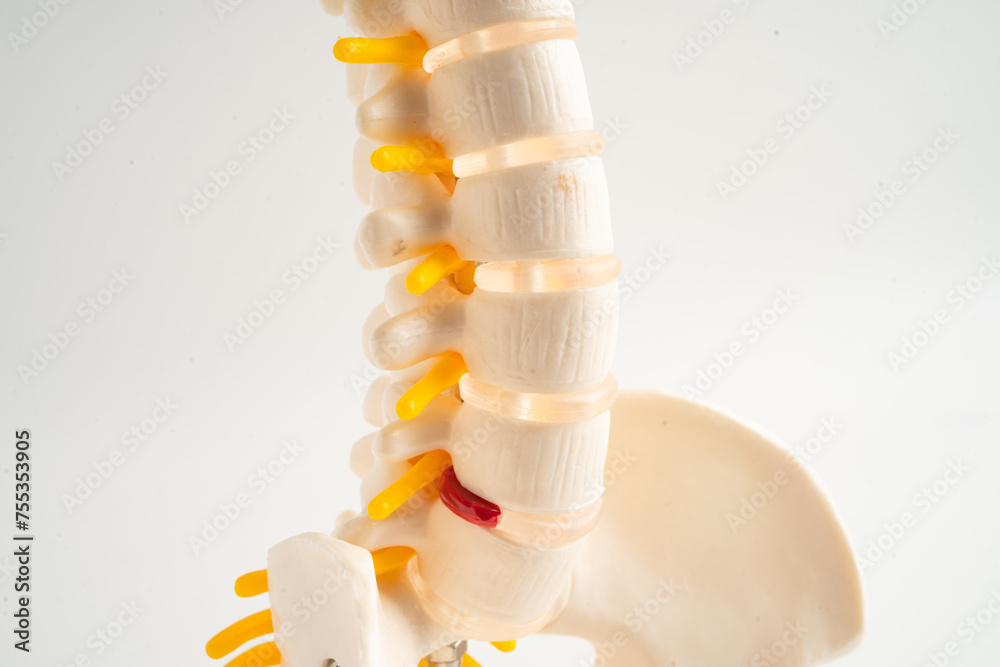 Lumbar spine displaced herniated disc fragment, spinal nerve and bone ...