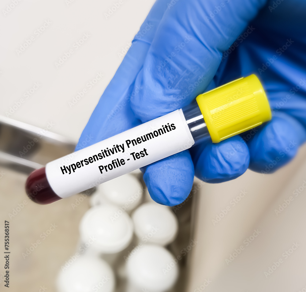 Blood sample for Hypersensitivity Pneumonitis Profile test to detect of ...