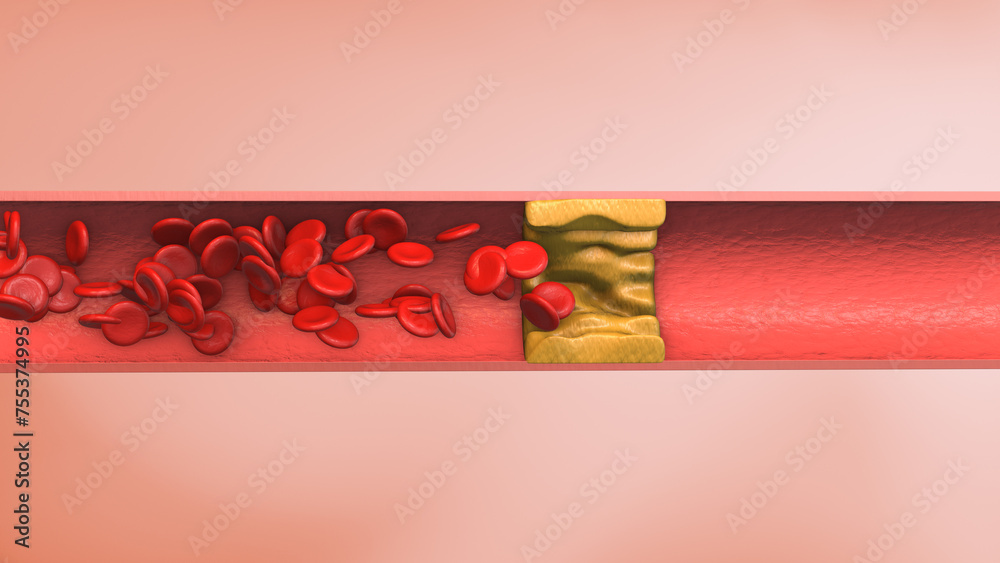 Artery blood clot medical animation Stock Illustration | Adobe Stock