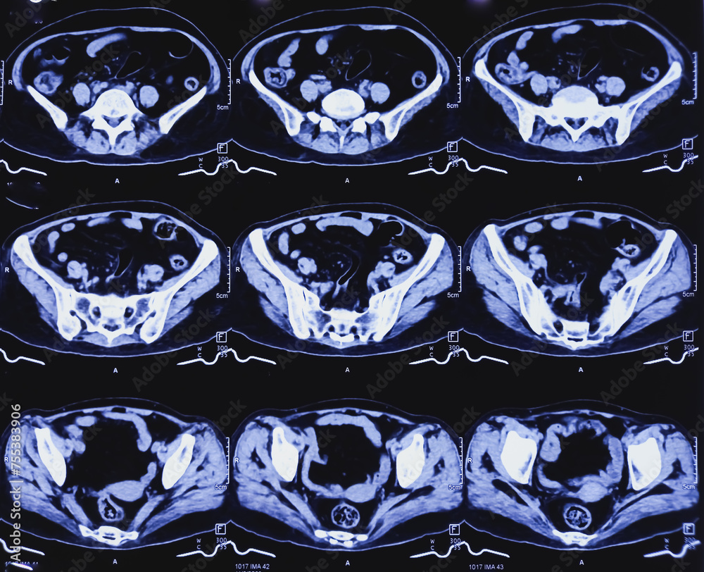 CT (Computed Tomography) scan of Whole abdomen. Soft tissue mass in ...