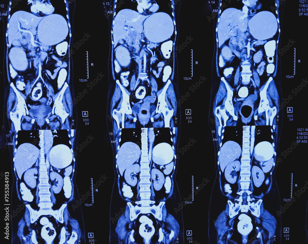 CT (Computed Tomography) scan of Whole abdomen. Soft tissue mass in ...