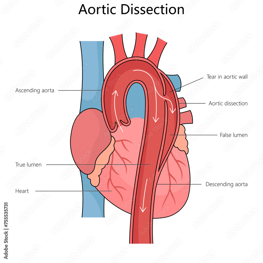 Human aortic dissection, showing the true and false lumens and a tear ...
