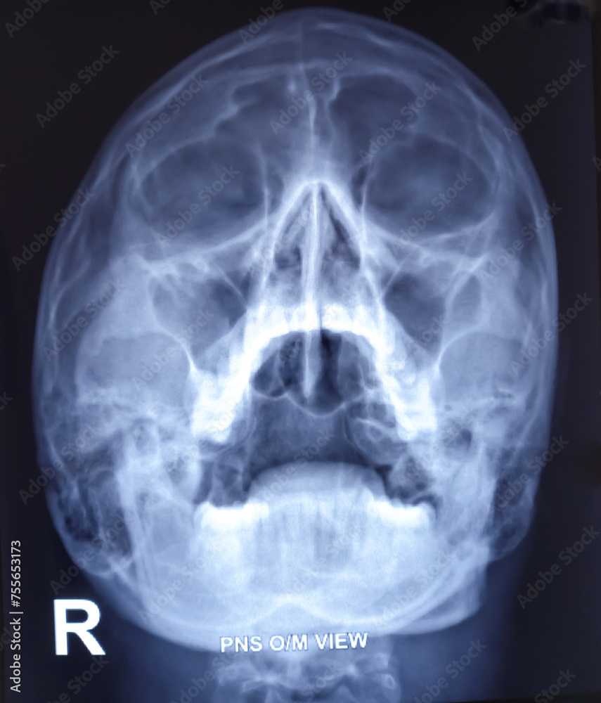 PNS Xray OM view film, bilateral maxillary and frontal sinusitis with ...