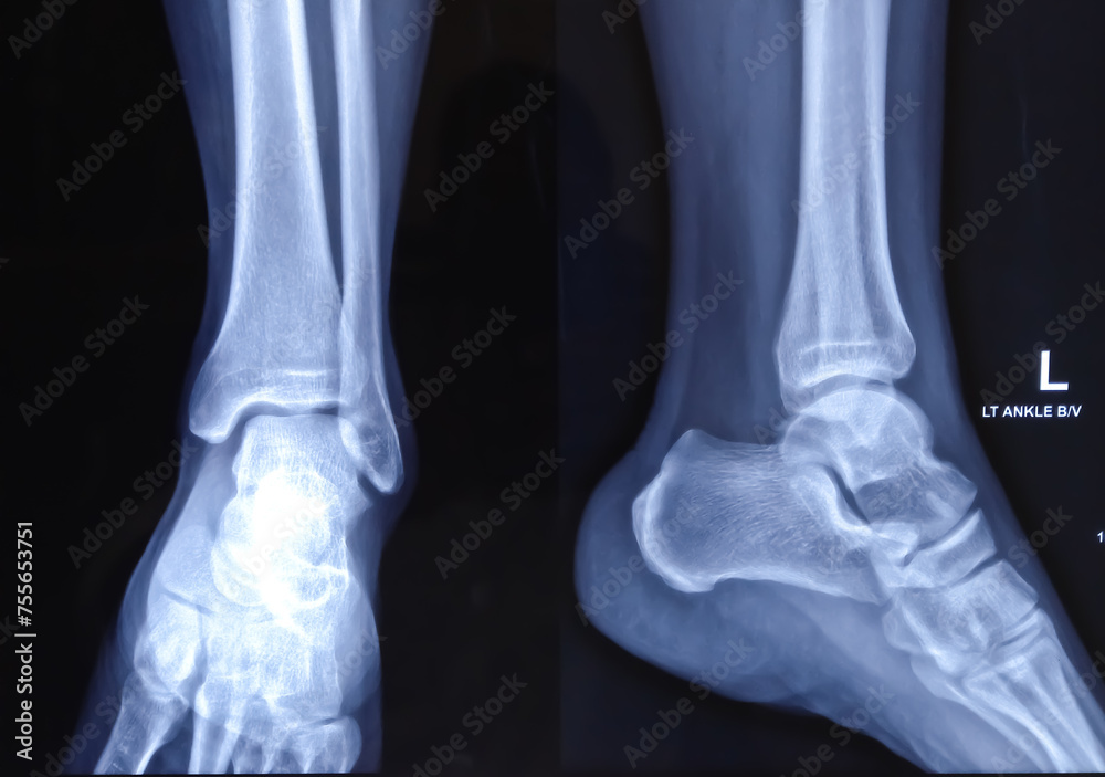 X-ray or radiograph of an ankle showing anatomy of bones and joint of ...