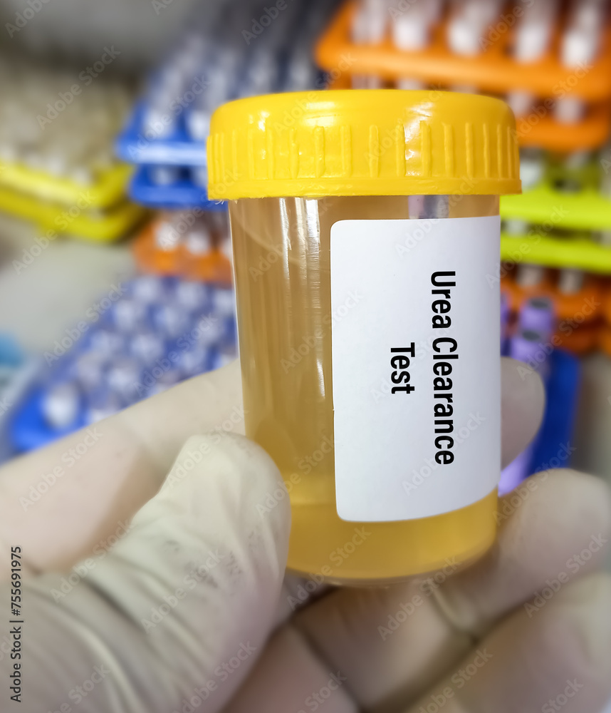 Urine sample for Urea clearance test for diagnosis of renal or kidney ...