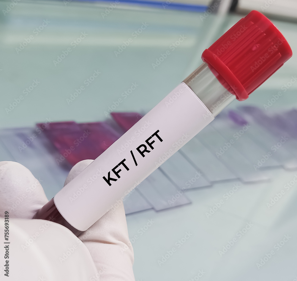 Blood sample for Renal Function test (Creatinine, BUN, eGFR, albumin ...