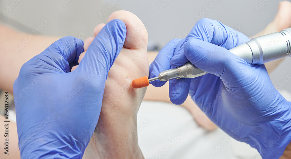 Podiatrist using a medical drill to remove a callosity (hyperkeratosis ...
