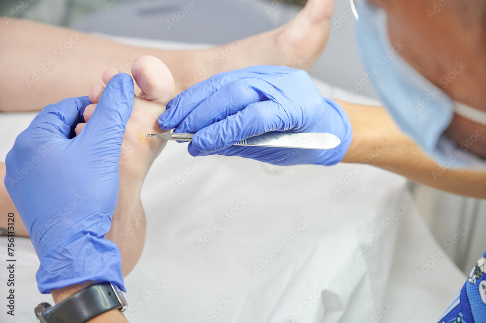 Podiatrist doctor checks the feet of a patient who needs to remove a ...