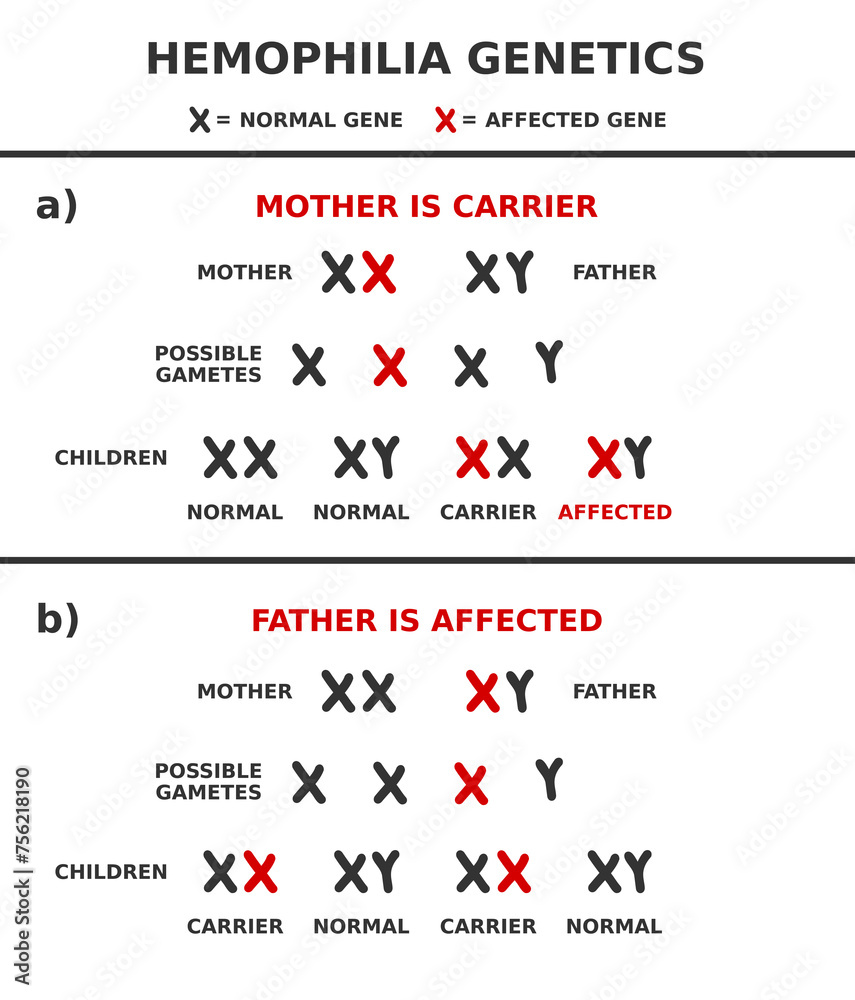 Hemophilia genetics infographic. Hemophilia is an X-linked recessive hereditary disorder ...