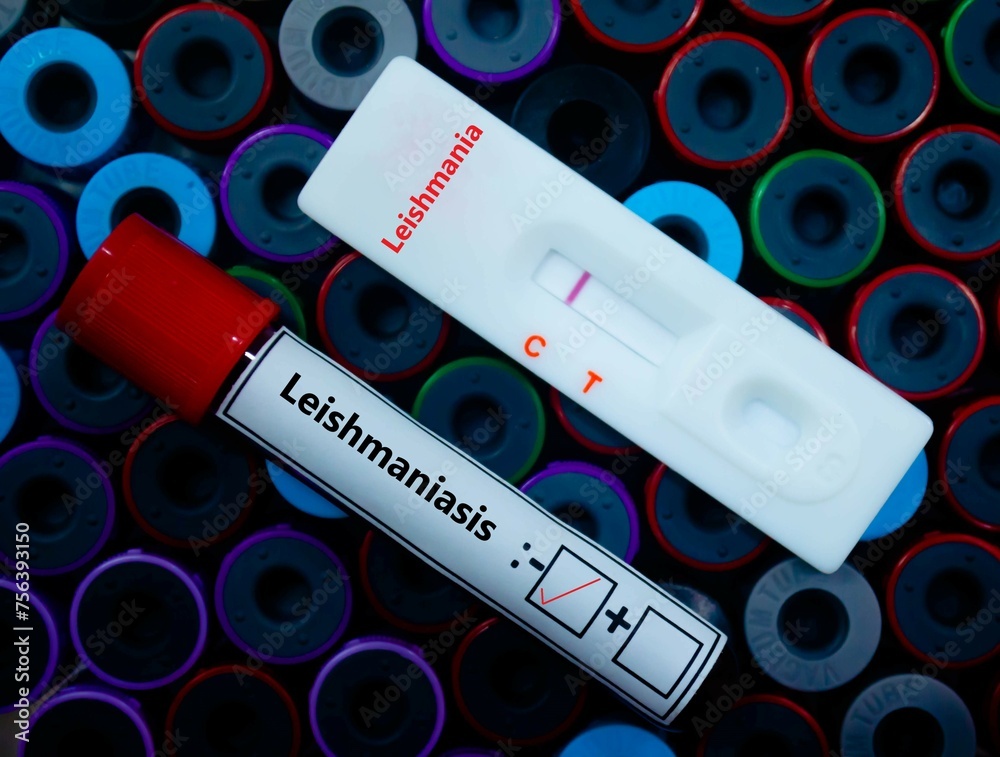 Blood sample of patient negative tested for leishmaniasis by rapid ...