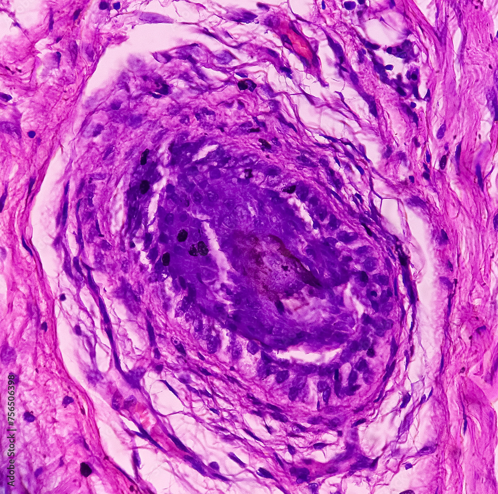 Tissue From Axilla Biopsy Invasive Squamous Cell Carcinoma Smear
