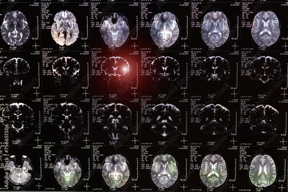 MRI, MRT, CT scan image of human brain. Medical treatmant concept ...