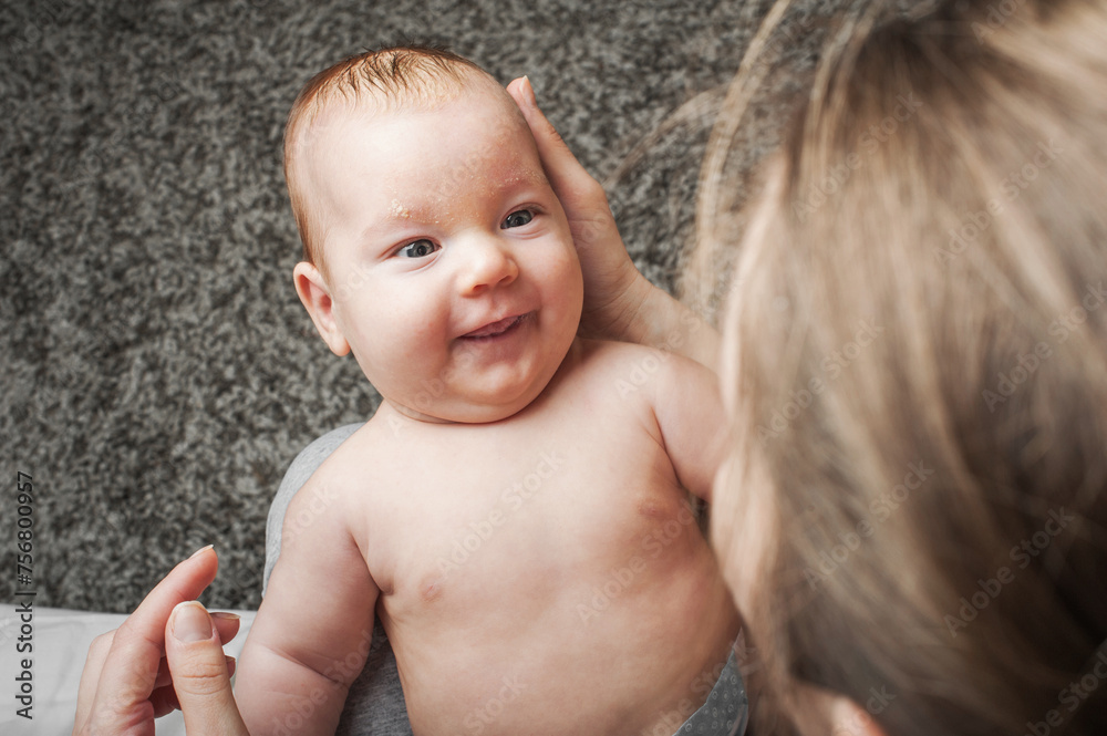 Seborrheic dermatitis in newborns. Newborn 2 month old baby with mom in ...