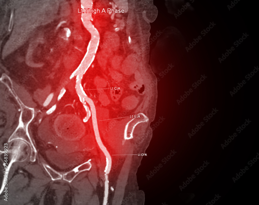 CTA femoral artery run off image of femoral artery for diagnosis Acute ...