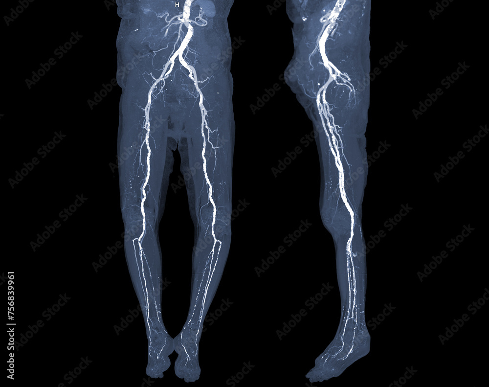 CTA femoral artery run off image of femoral artery for diagnosis Acute ...