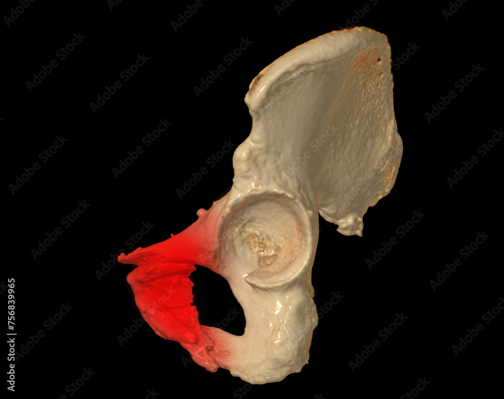 CT Scan of pelvic bone 3D rendering image showing superior pubic ramus ...
