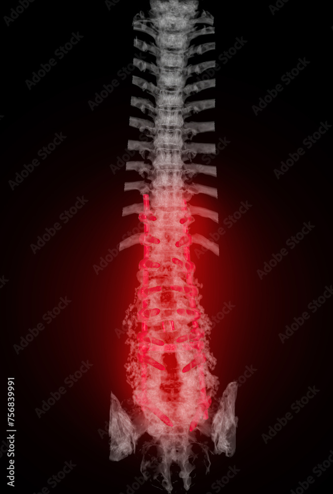 CT scan of thoracic and lumbar spine 3d rendering showing pedicle screw implant after surgical ...