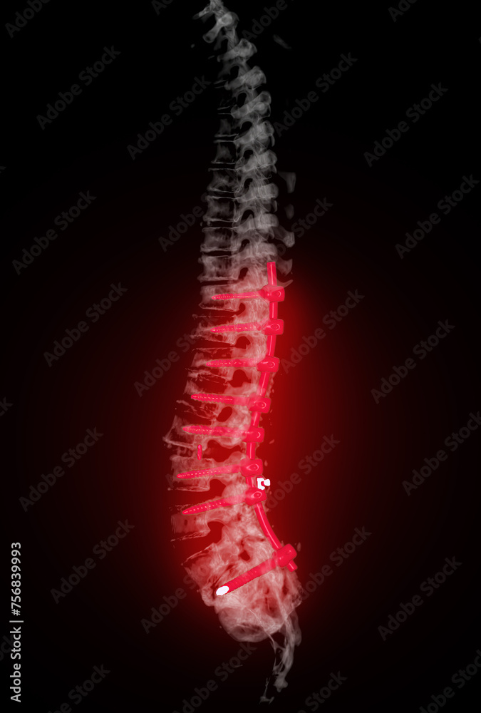 CT scan of thoracic and lumbar spine 3d rendering showing pedicle screw ...